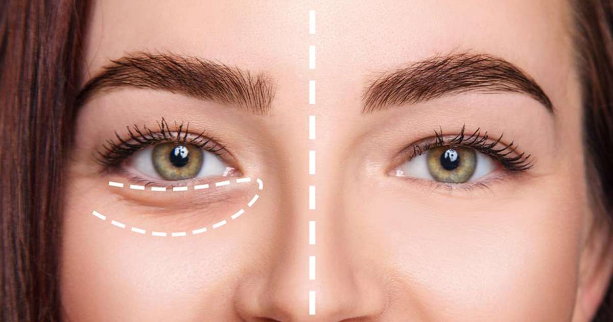Under-eye light fillers – Medivia